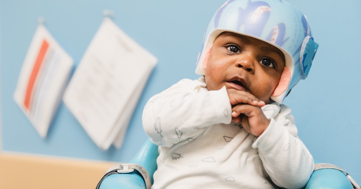 Plagiocephaly Treatment Options | OrthoPediatrics Specialty Bracing